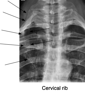 Cervical rib casefile explains the profound tingling in arms and hands