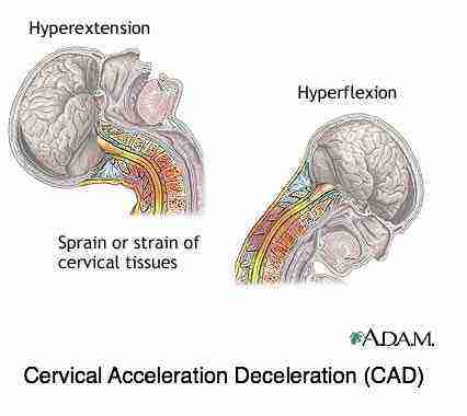 Symptoms of whiplash describes the mechanics and symptoms after trauma.